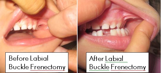 Labial Frenectomy Buckle Before After Pictures Debug Your Health