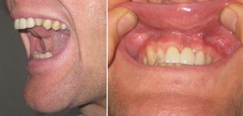 No Lingual Or Labial Frenectomy Needed Debug Your Health