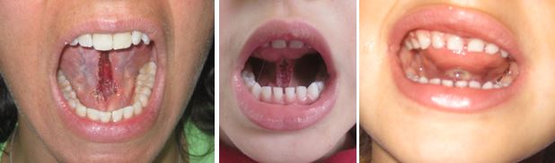Frenectomy Debug Your Health