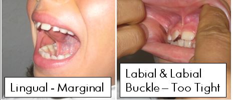 Frenectomy Debug Your Health